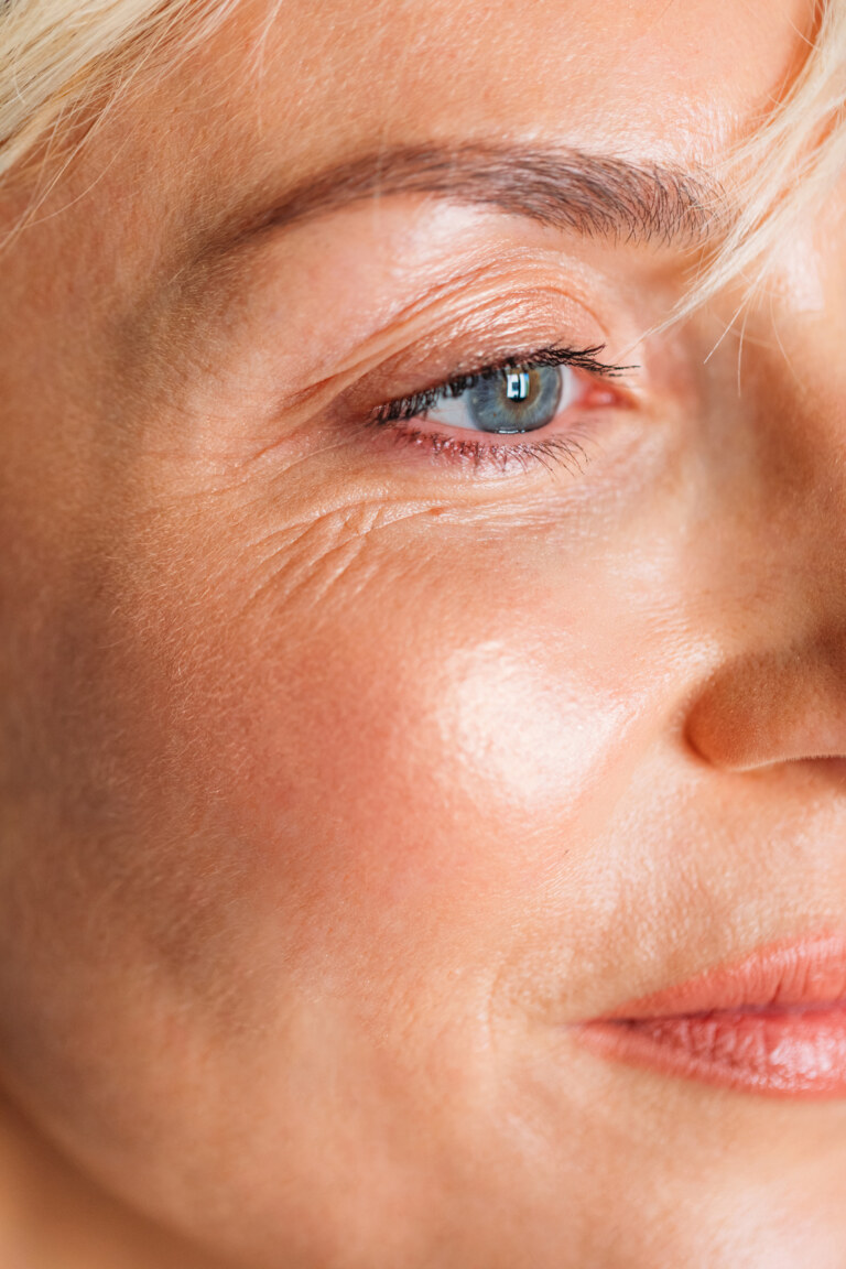 Sejas ovāla korekcija ar SiluetSoft diegiem | Latvian Microsurgery center